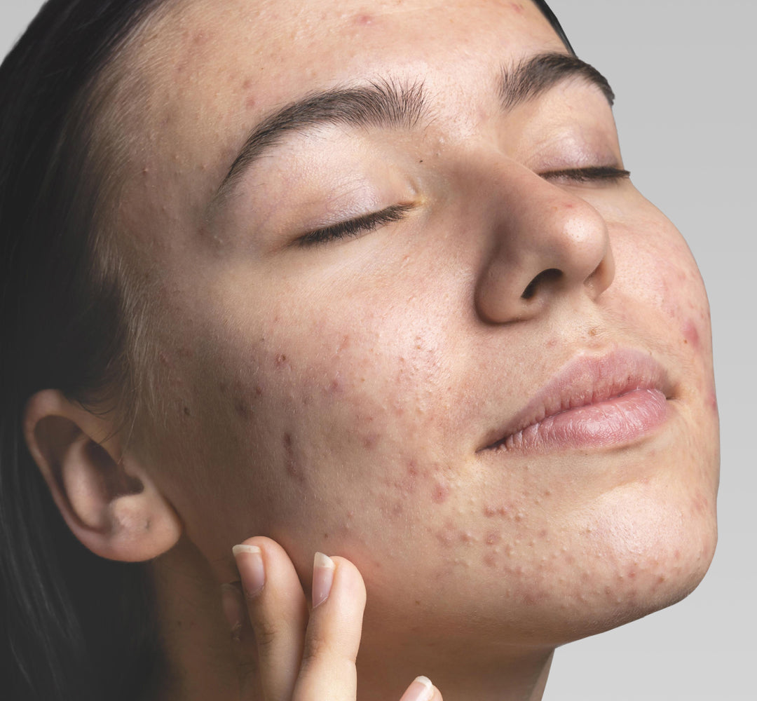 Hormonal Acne: Causes, Treatments, and Prevention – Vue Swiss