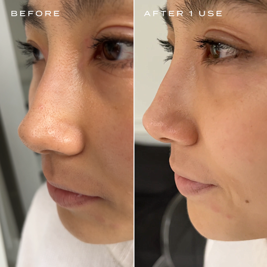 NOSE PATCHES – Vue Swiss