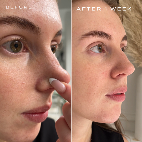 NOSE PATCHES – Vue Swiss